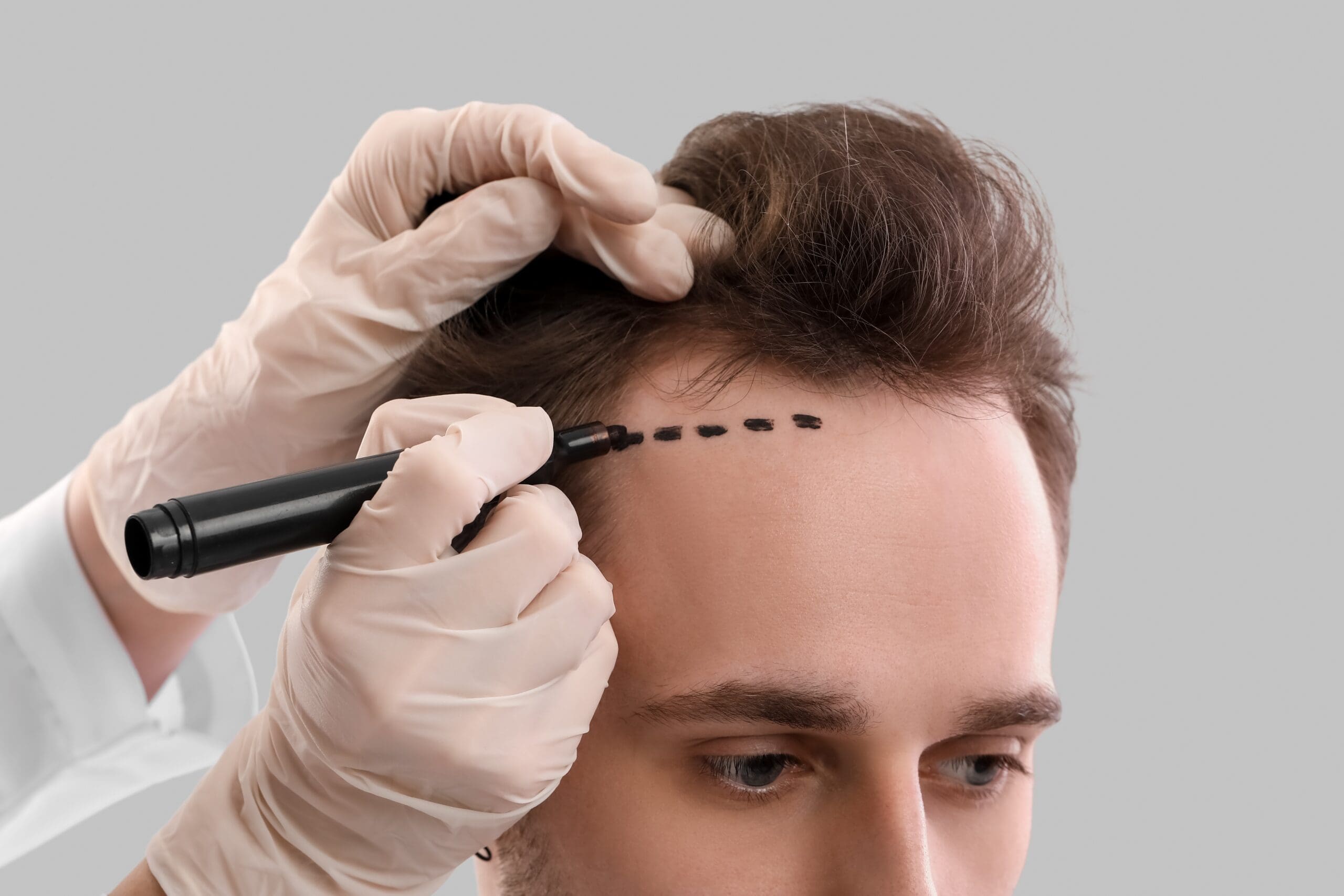 What Are the Top Hair Transplant Methods for Men? - He Clinic for Men